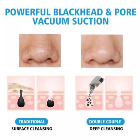 Electric Suction Blackhead Instrument – Jutishop.pk
